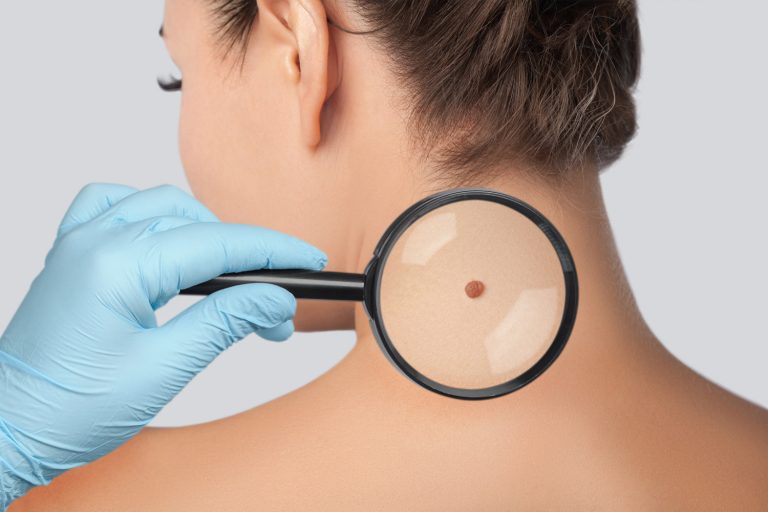 Hauttumor / Muttermal Entfernung